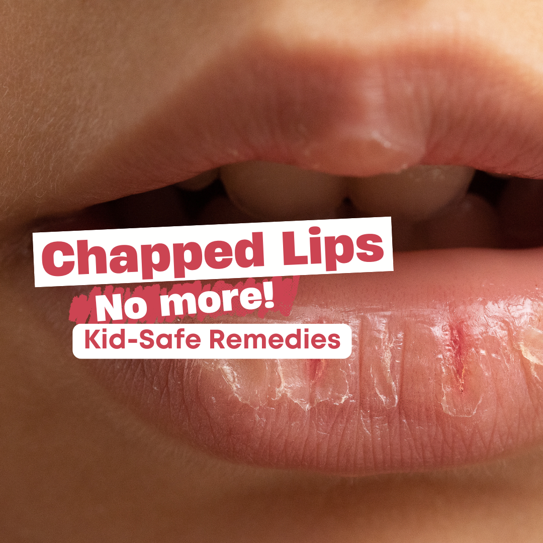 How to Treat and Prevent Chapped Lips in Children
